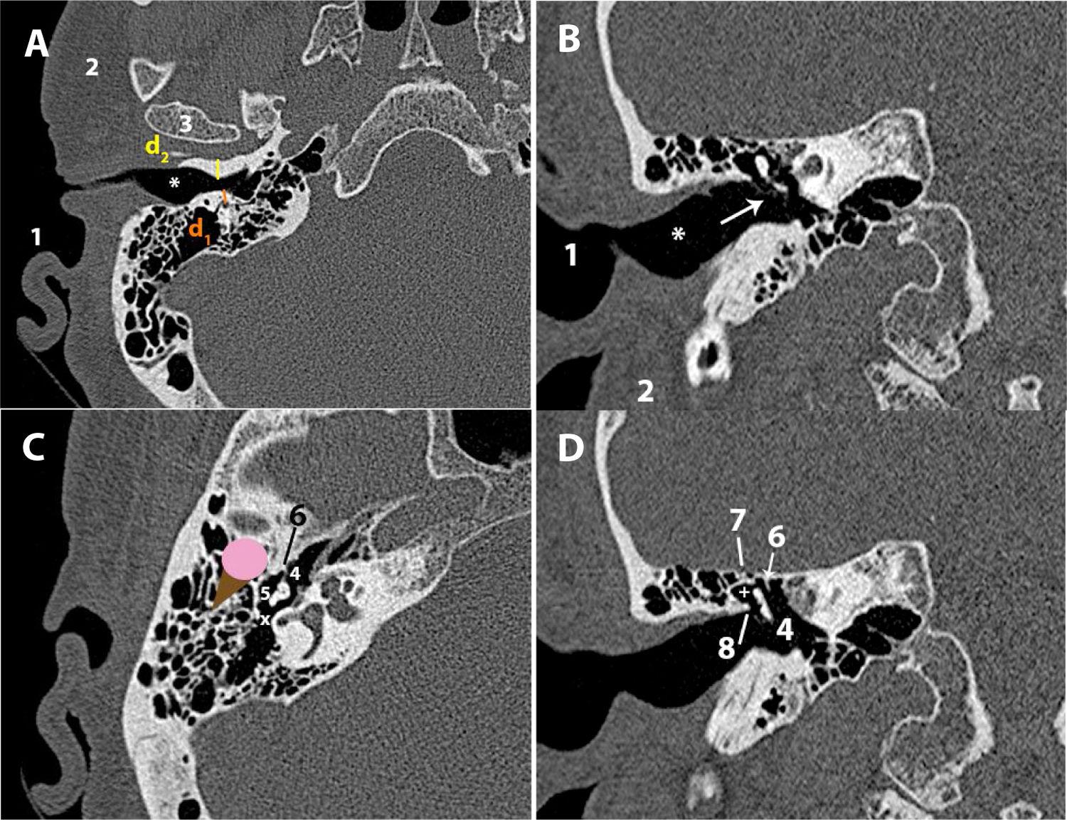 Lista de verificación de tomografía computarizada de hueso temporal y ...