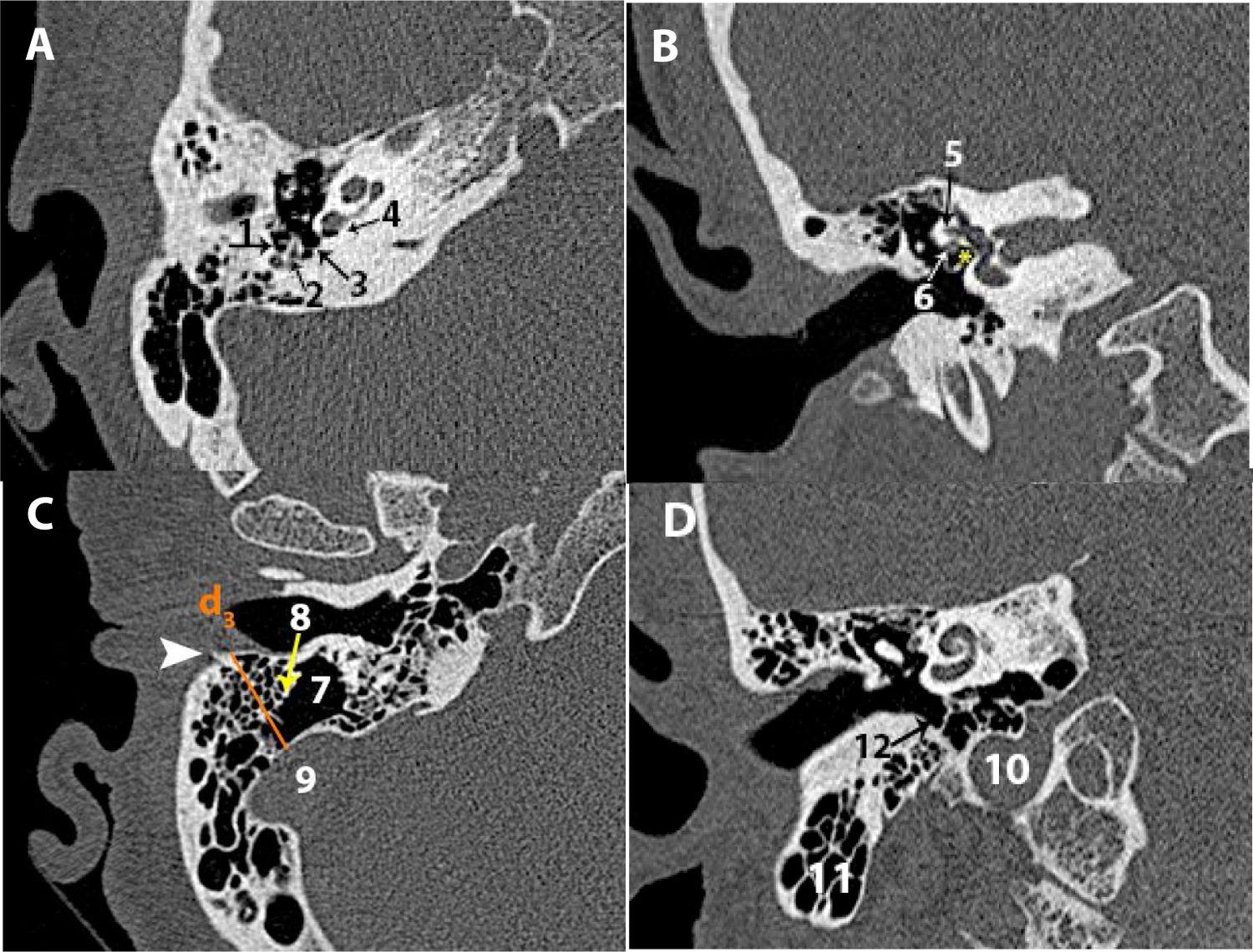 Lista de verificación de tomografía computarizada de hueso temporal y ...