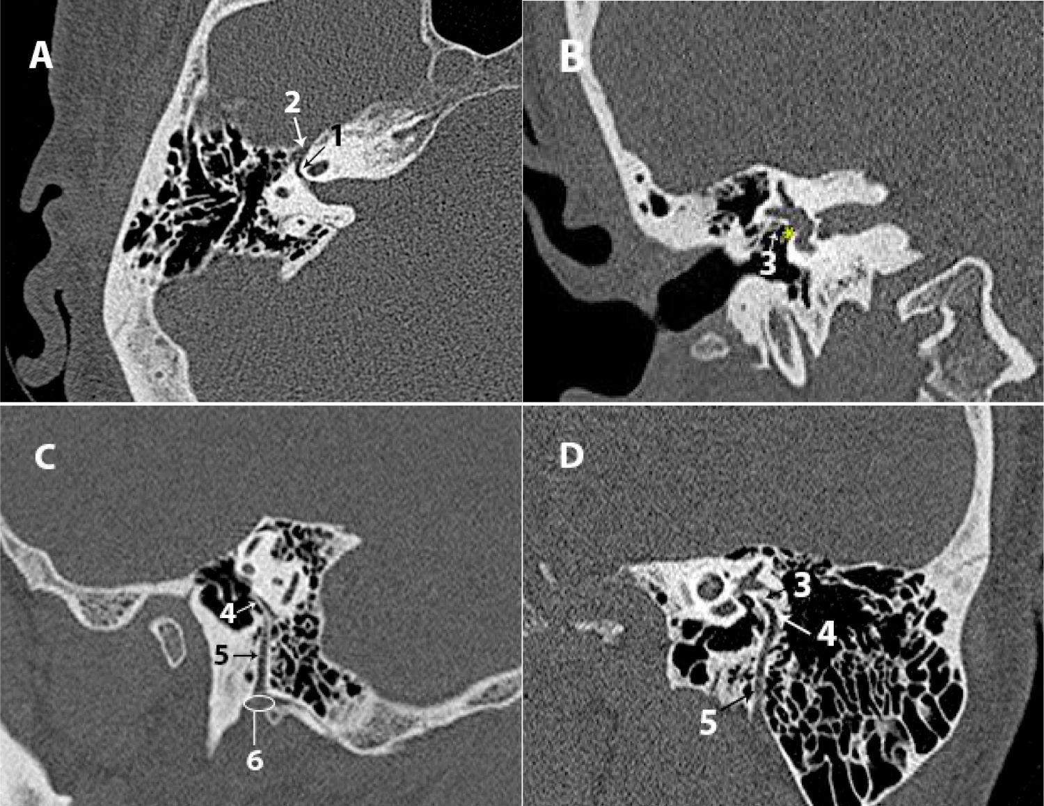 Lista de verificación de tomografía computarizada de hueso temporal y ...