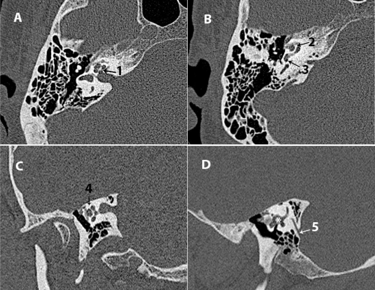 Lista de verificación de tomografía computarizada de hueso temporal y ...
