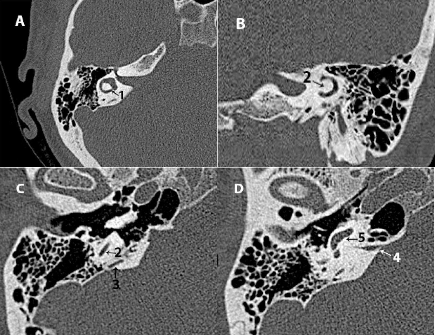 Lista de verificación de tomografía computarizada de hueso temporal y ...