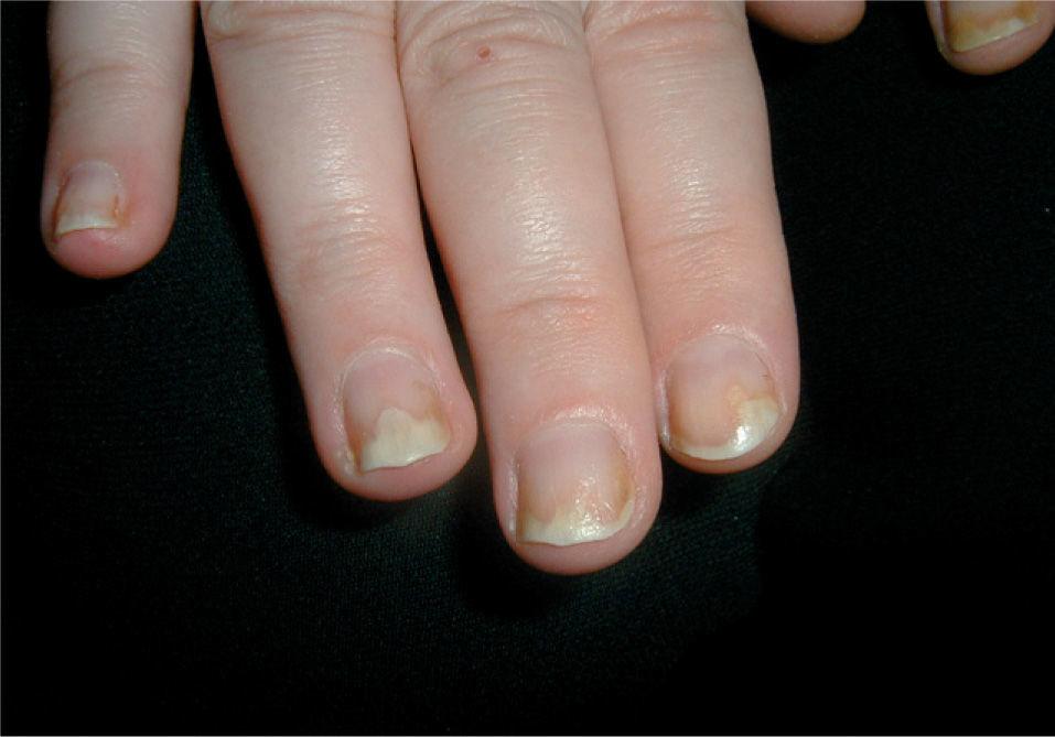 Aspectos diagnósticos y terapéuticos de la psoriasis ungueal | Actas ...