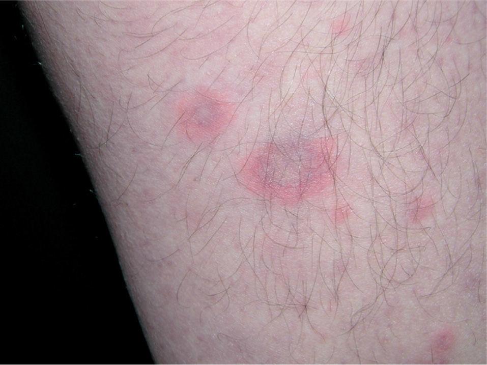 Dermatosis neutrofílica crónica recurrente: una posible variante en el ...