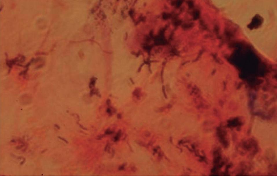 Eritrasma interdigital: datos clínicos, epidemiológicos y ...