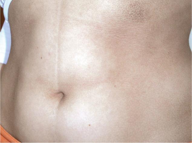 Acantosis Nigricans ScienceDirect, 59% OFF