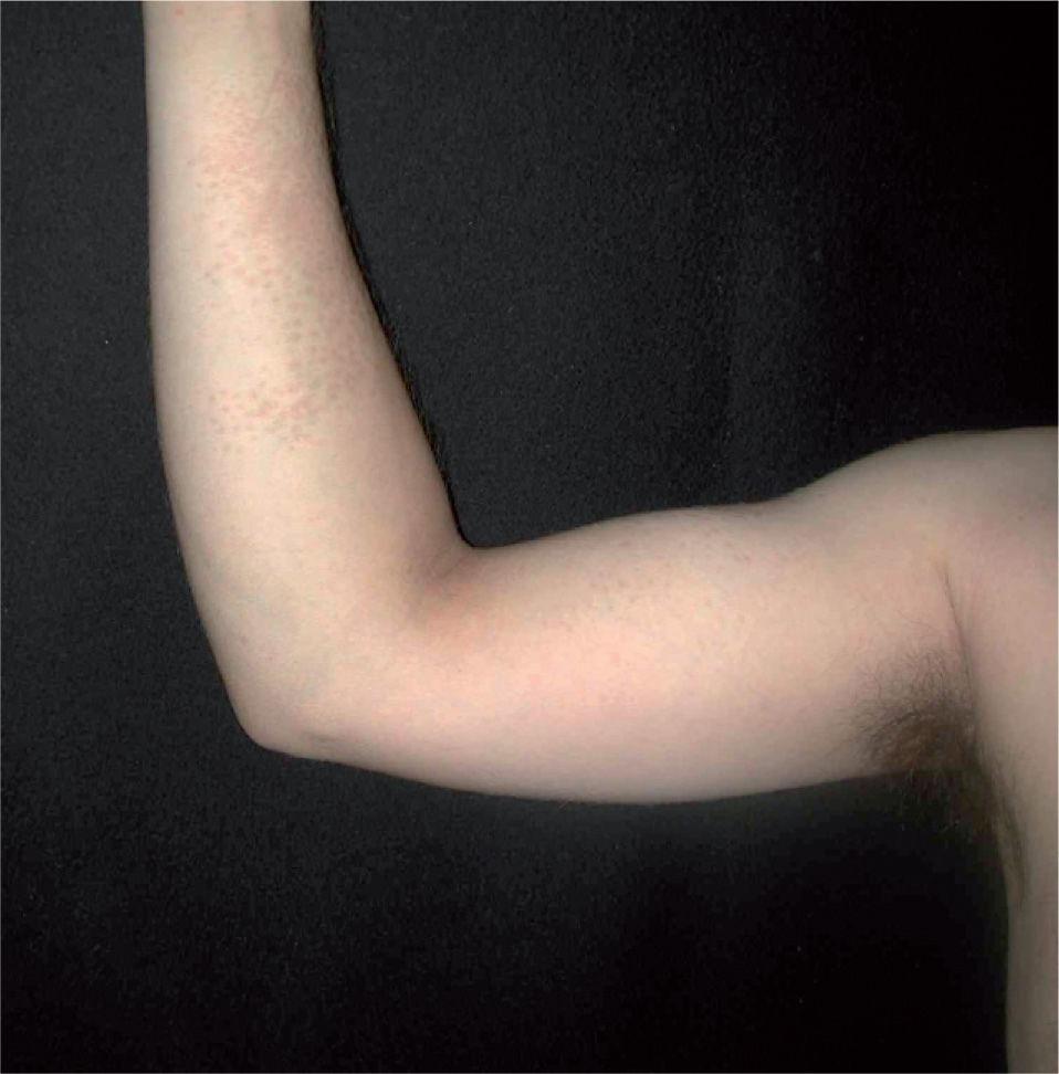 Coexistencia de morfea en gotas generalizada y liquen escleroatrófico ...