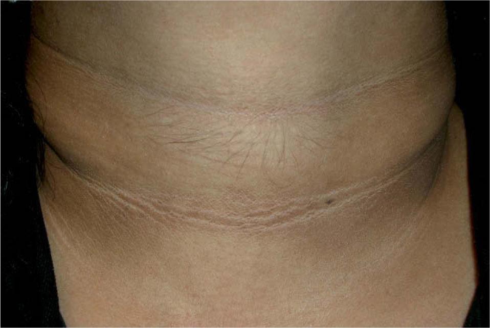 Hipertricosis cervical anterior esporádica | Actas Dermo-Sifiliográficas