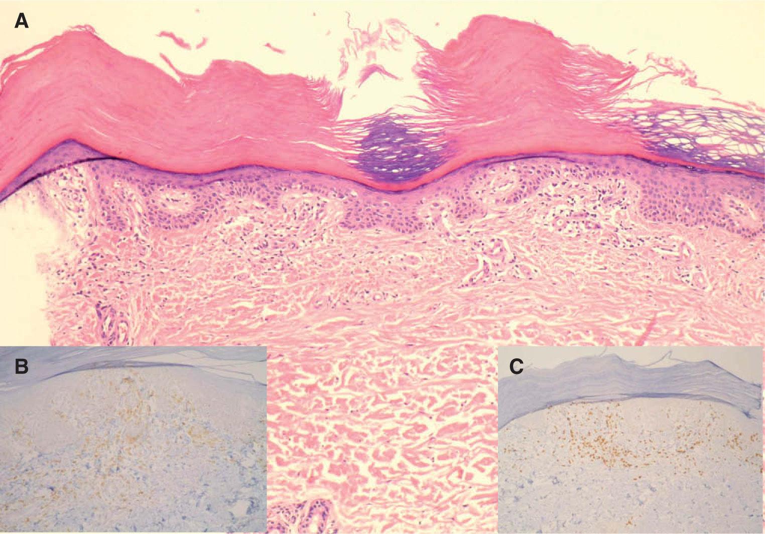 Hiperqueratosis lenticularis perstans (enfermedad de Flegel) con ...