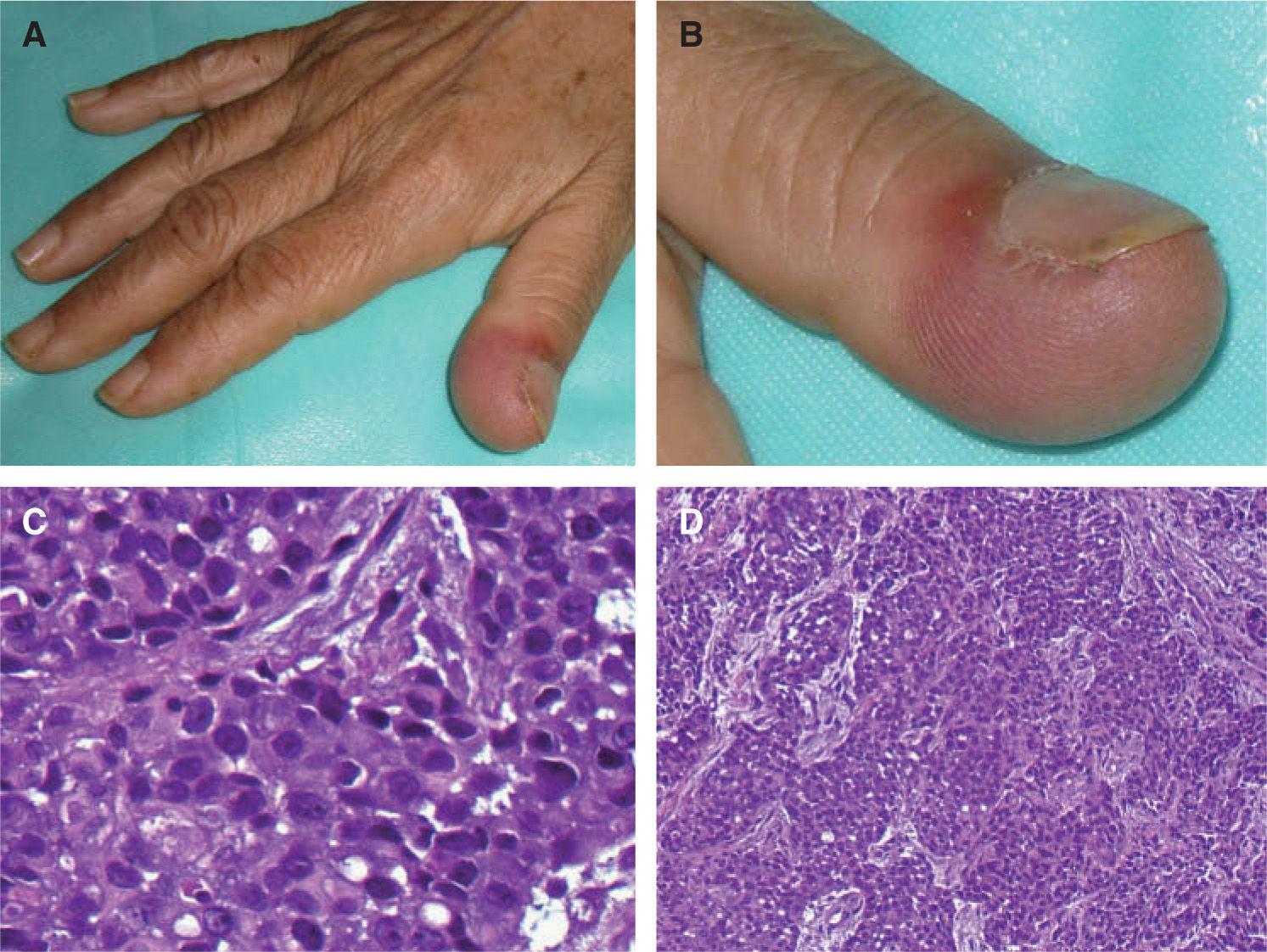Dactilitis crónica indolora como hallazgo inicial de un adenocarcinoma ...