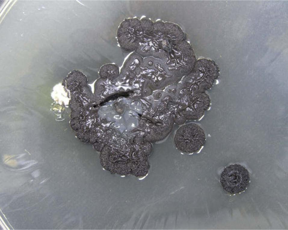 Nódulo ulcerado con lesiones satélites en el pulpejo del primer dedo de ...