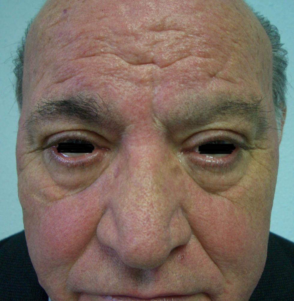 Facies leonina en el síndrome carcinoide | Actas Dermo-Sifiliográficas