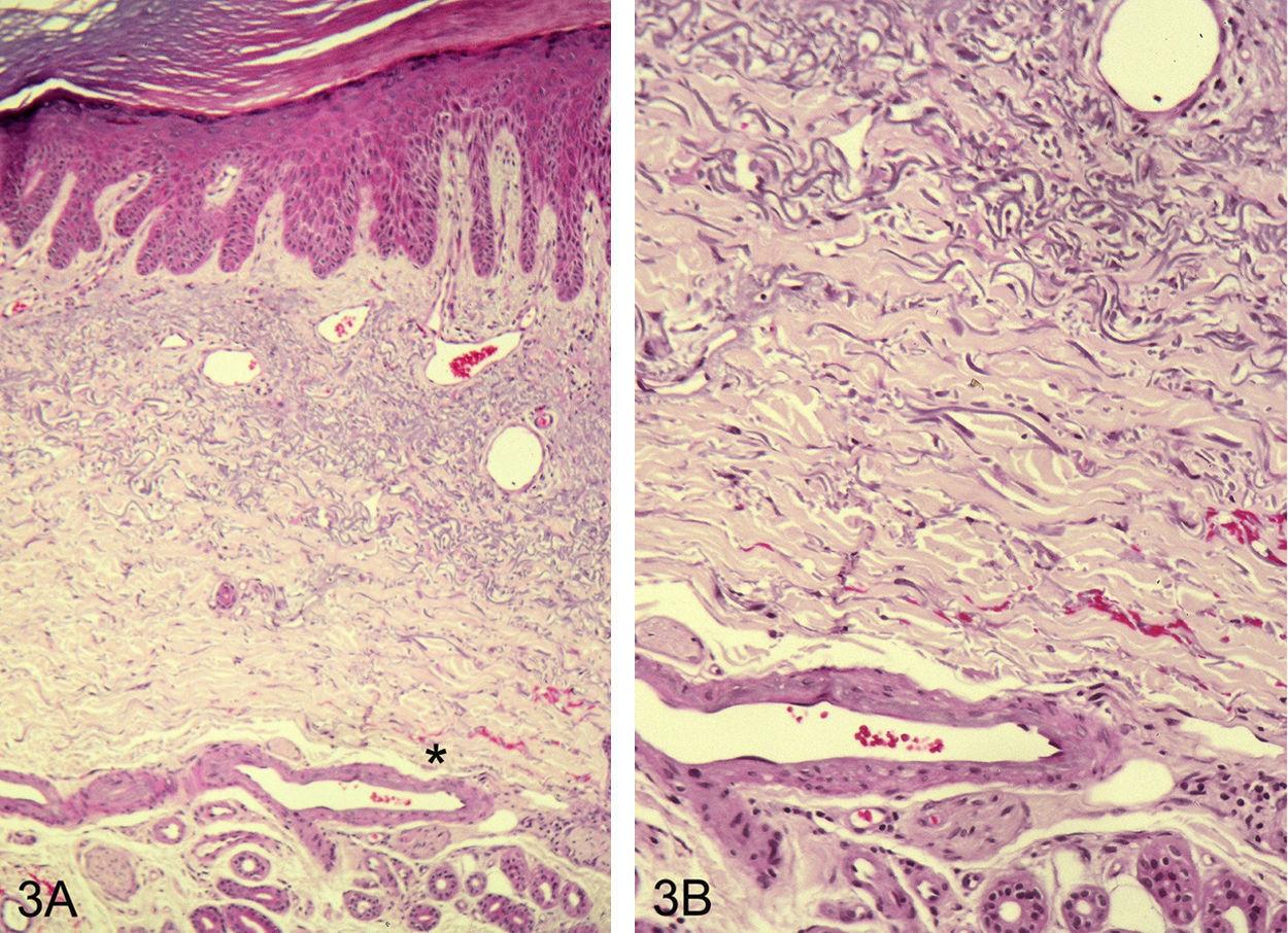 Elastosis solar en carcinomas espinocelulares cutáneos | Actas Dermo ...
