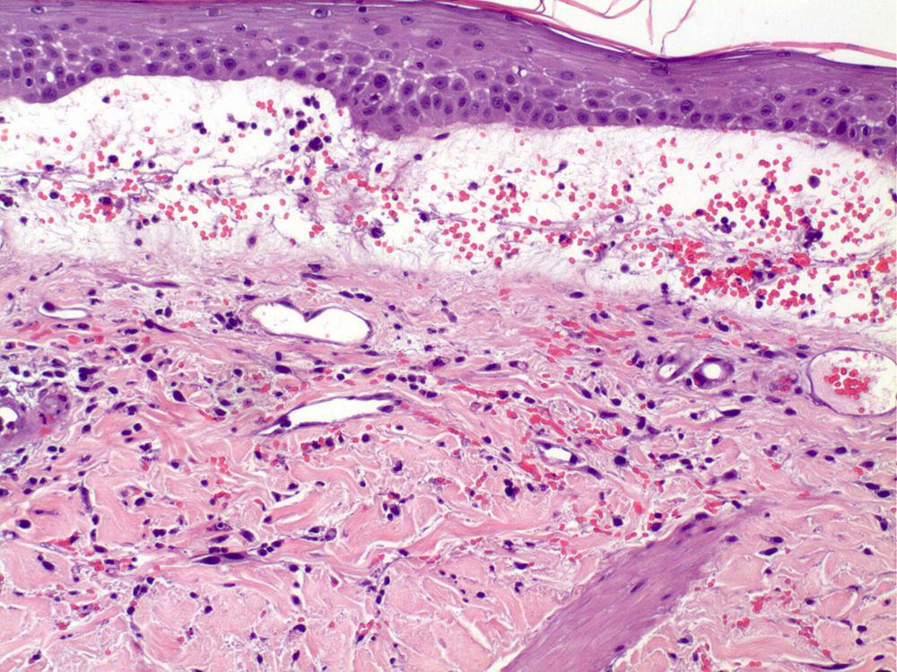 Dermatitis irritativa de contacto por Agave americana con componente ...