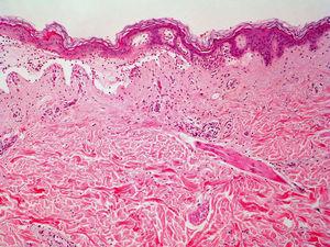 Aproximación al diagnóstico dermatopatológico de las lesiones figuradas ...