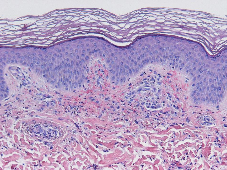 Vasculitis cutáneas | Actas Dermo-Sifiliográficas