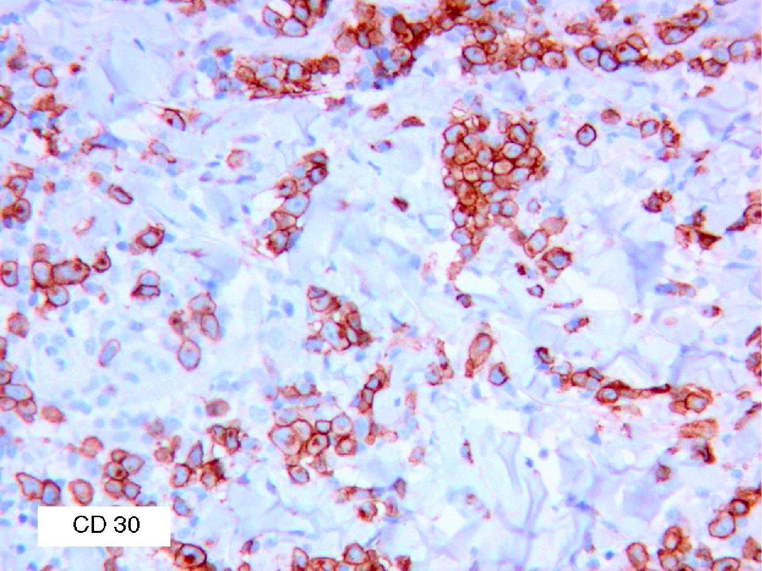 Cd30 Positivo O Que Significa - RETOEDU