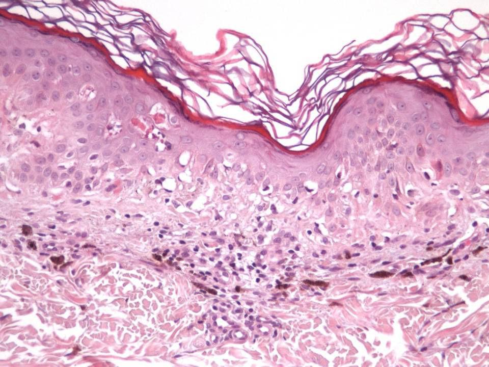 Regresión completa de nevos melanocíticos: correlación clínica ...