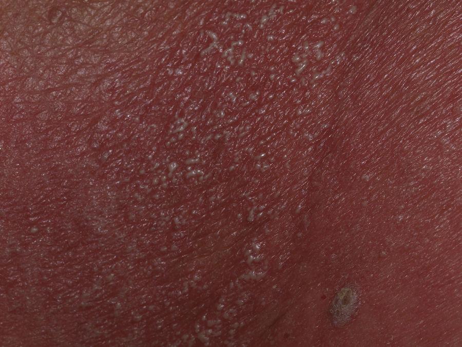 Pustulosis exantemática aguda generalizada inducida por nistatina ...