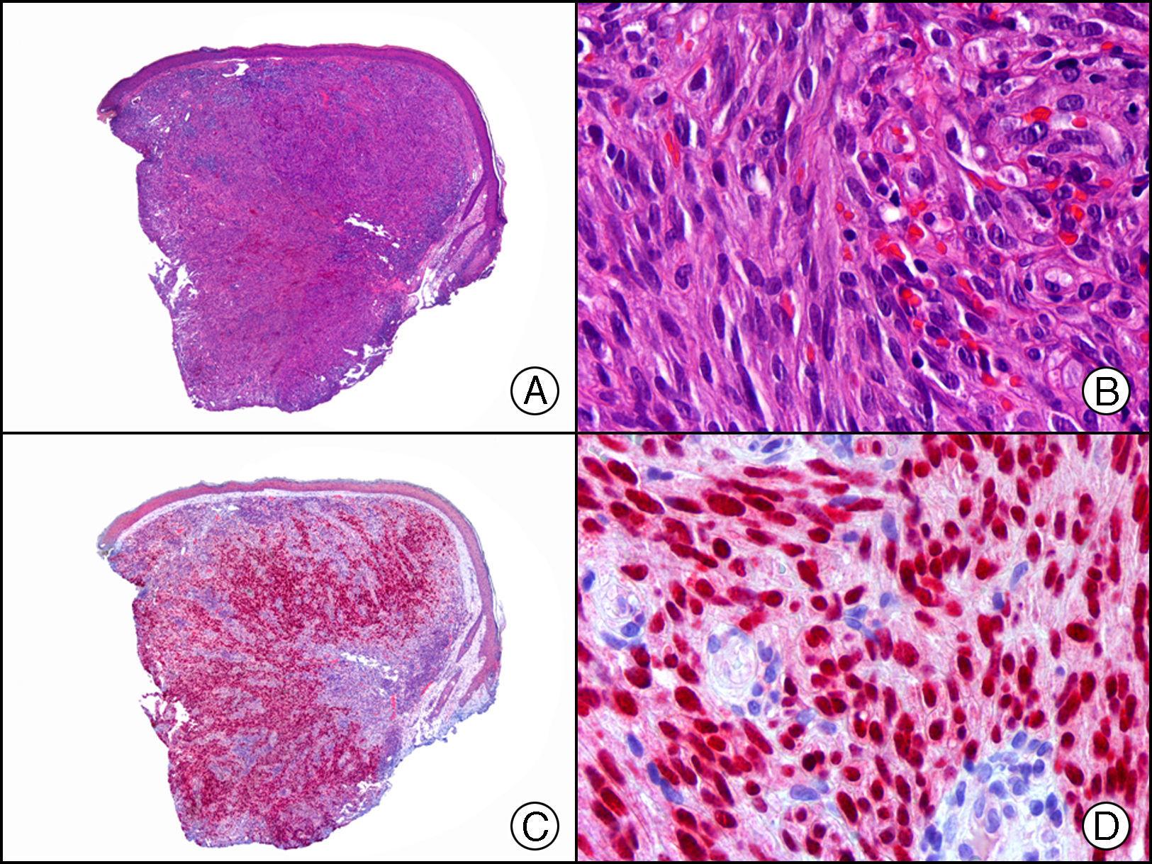 Inmunohistoquímica en dermatopatología: revisión de los anticuerpos ...