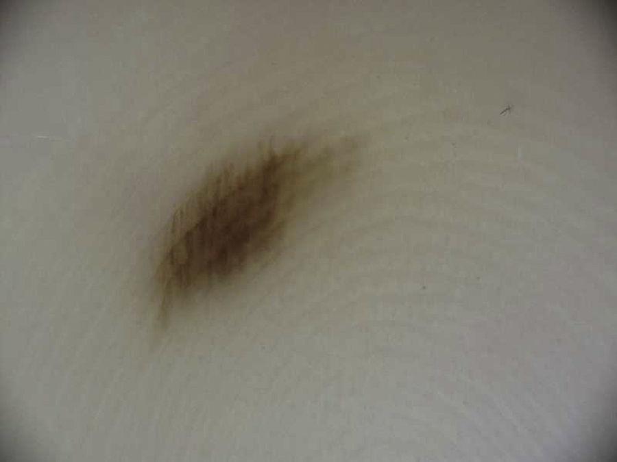 Dermoscopic Patterns of 158 Acral Melanocytic Nevi in a Latin American ...