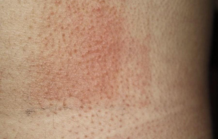 Estudio de las fotodermatosis idiopáticas y exógenas. Parte II: el ...