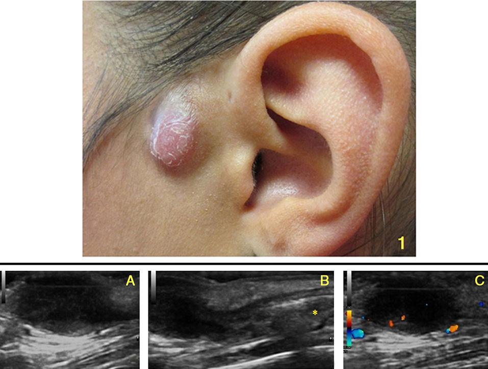 Fístula preauricular congénita complicada: características ecográficas ...