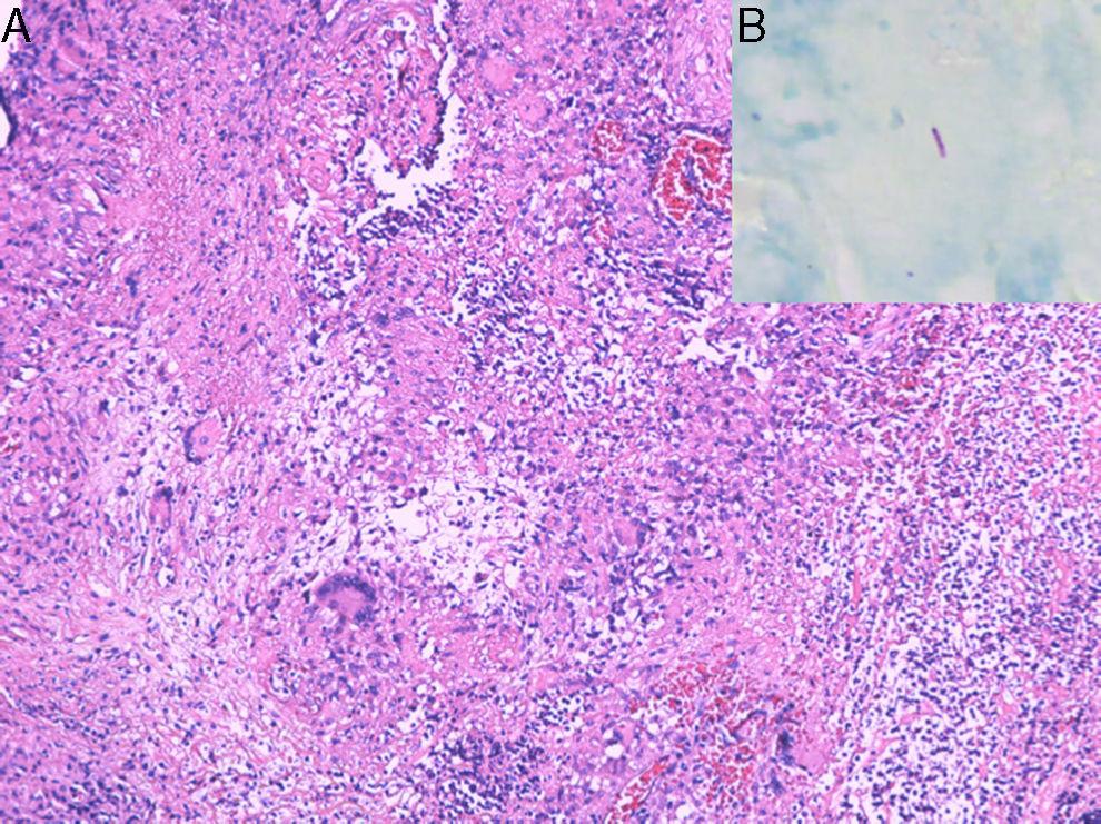 Patient with disseminated tuberculosis and rare perianal involvement ...