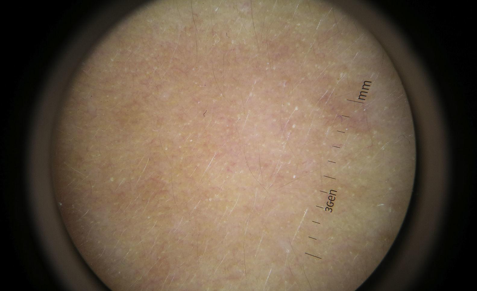 Hiperqueratosis folicular filiforme en la cara | Actas Dermo ...