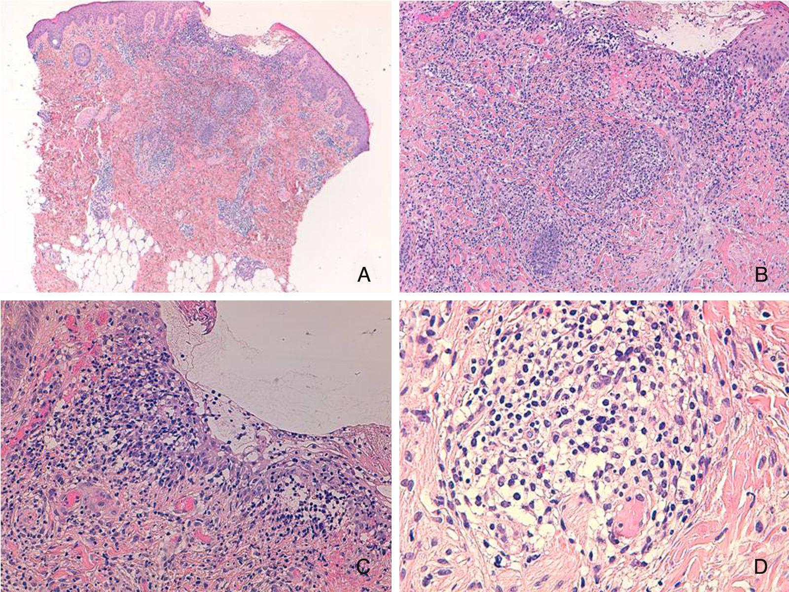 Histiocitosis de células indeterminadas en edad pediátrica: a propósito ...