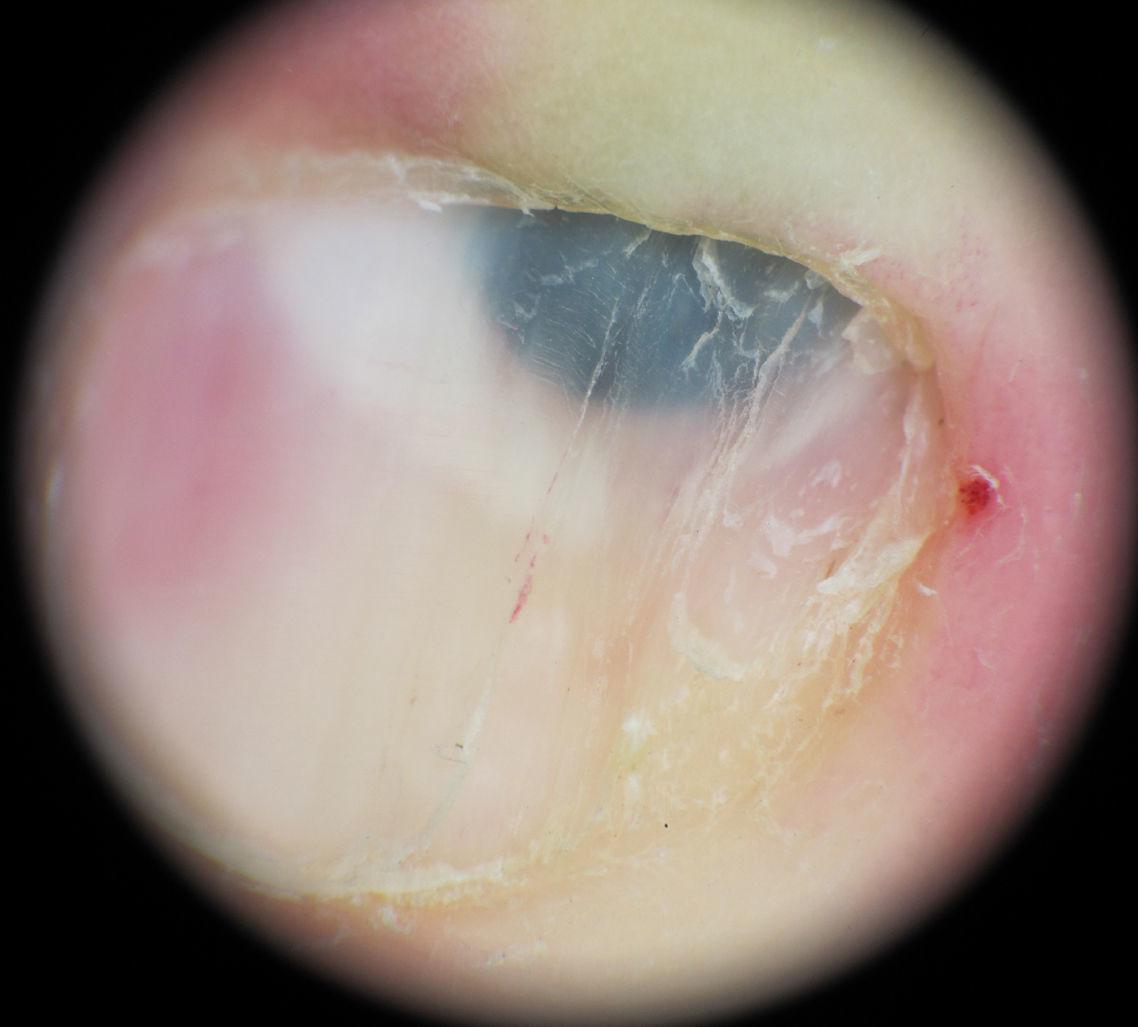 Nevus azul subungueal | Actas Dermo-Sifiliográficas