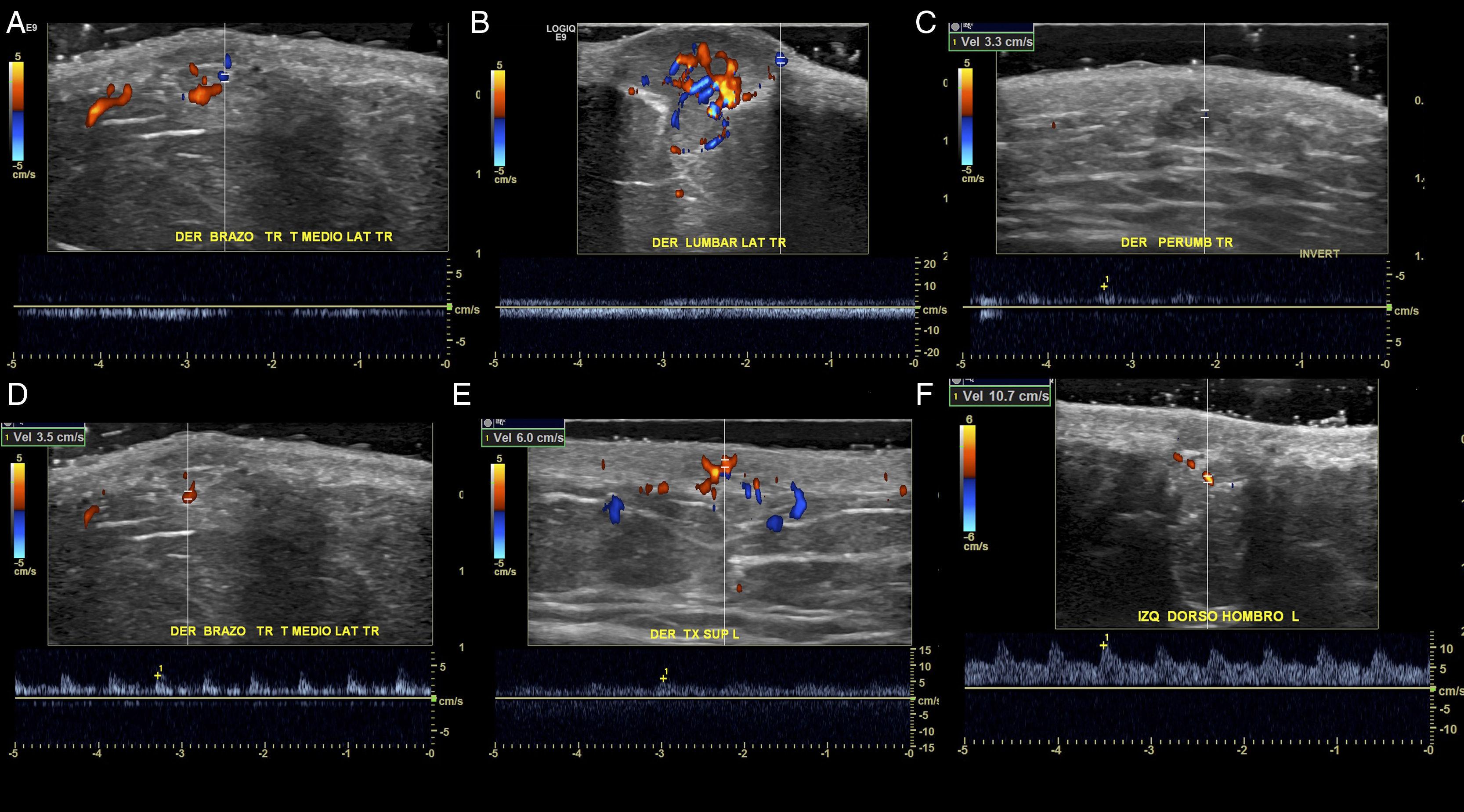Ecografía Doppler color en malformaciones glomuvenosas con correlación ...