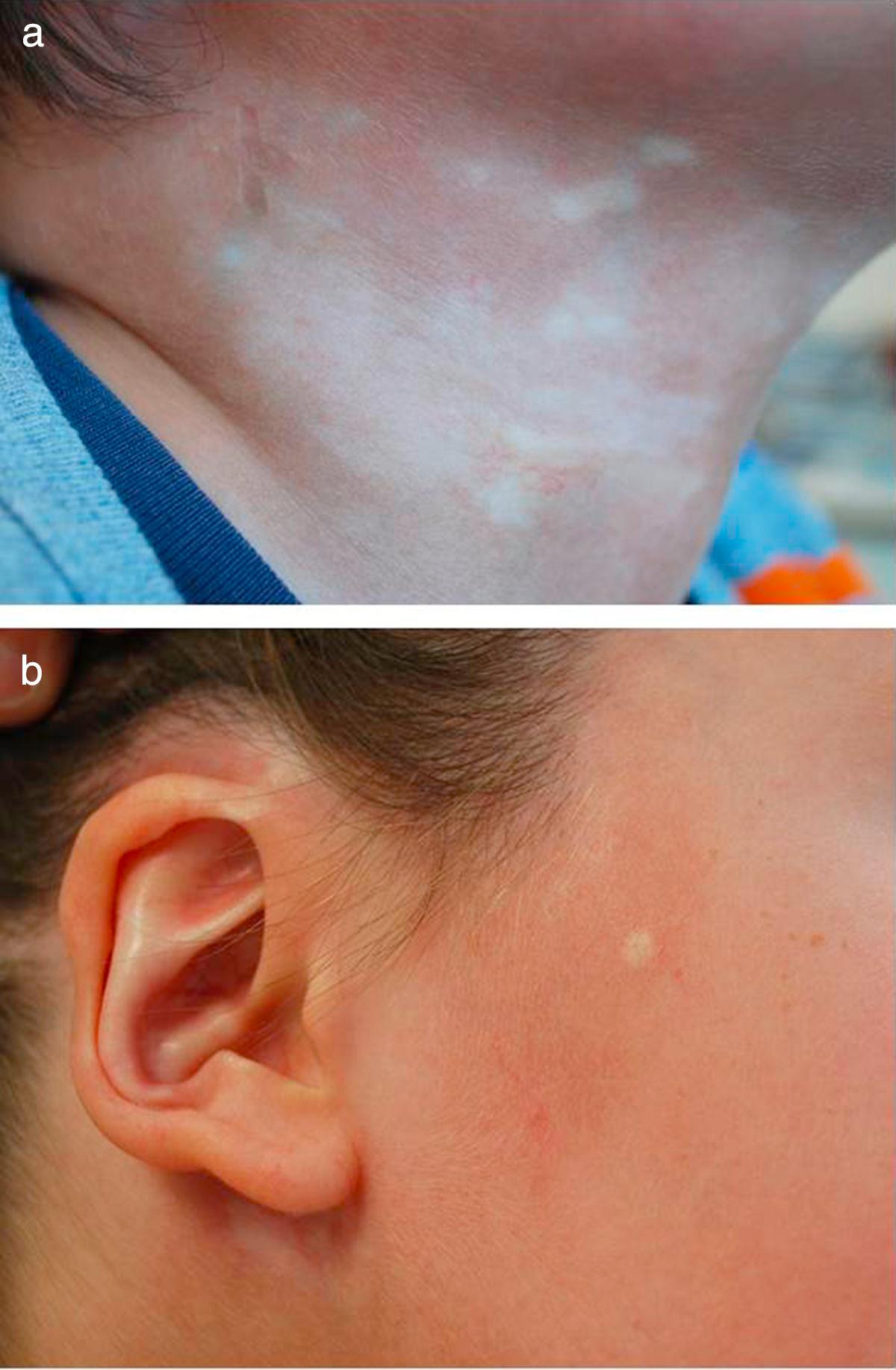 Morfea en la infancia: actualización | Actas Dermo-Sifiliográficas