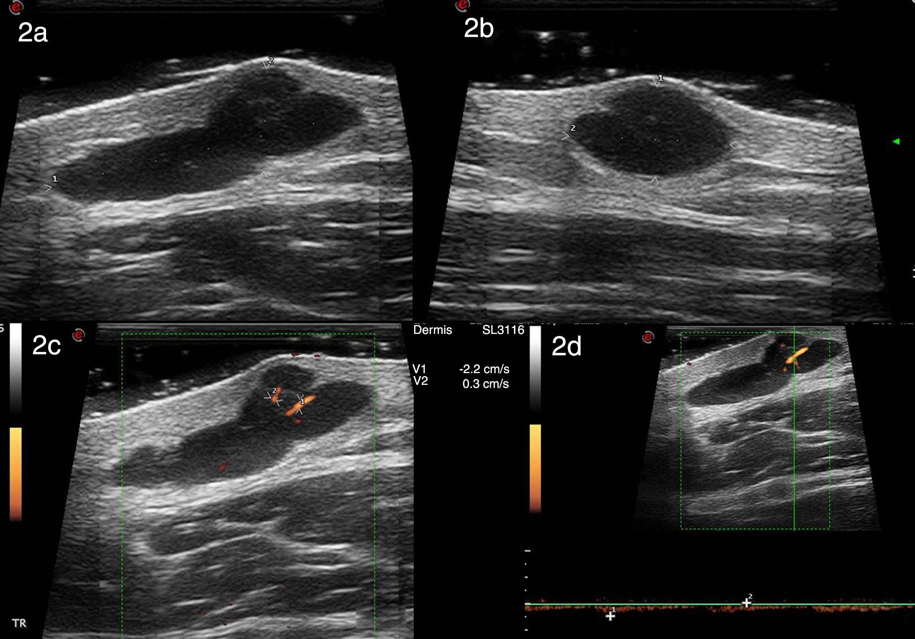 Utilidad de la ecografía en el diagnóstico diferencial de un nódulo ...
