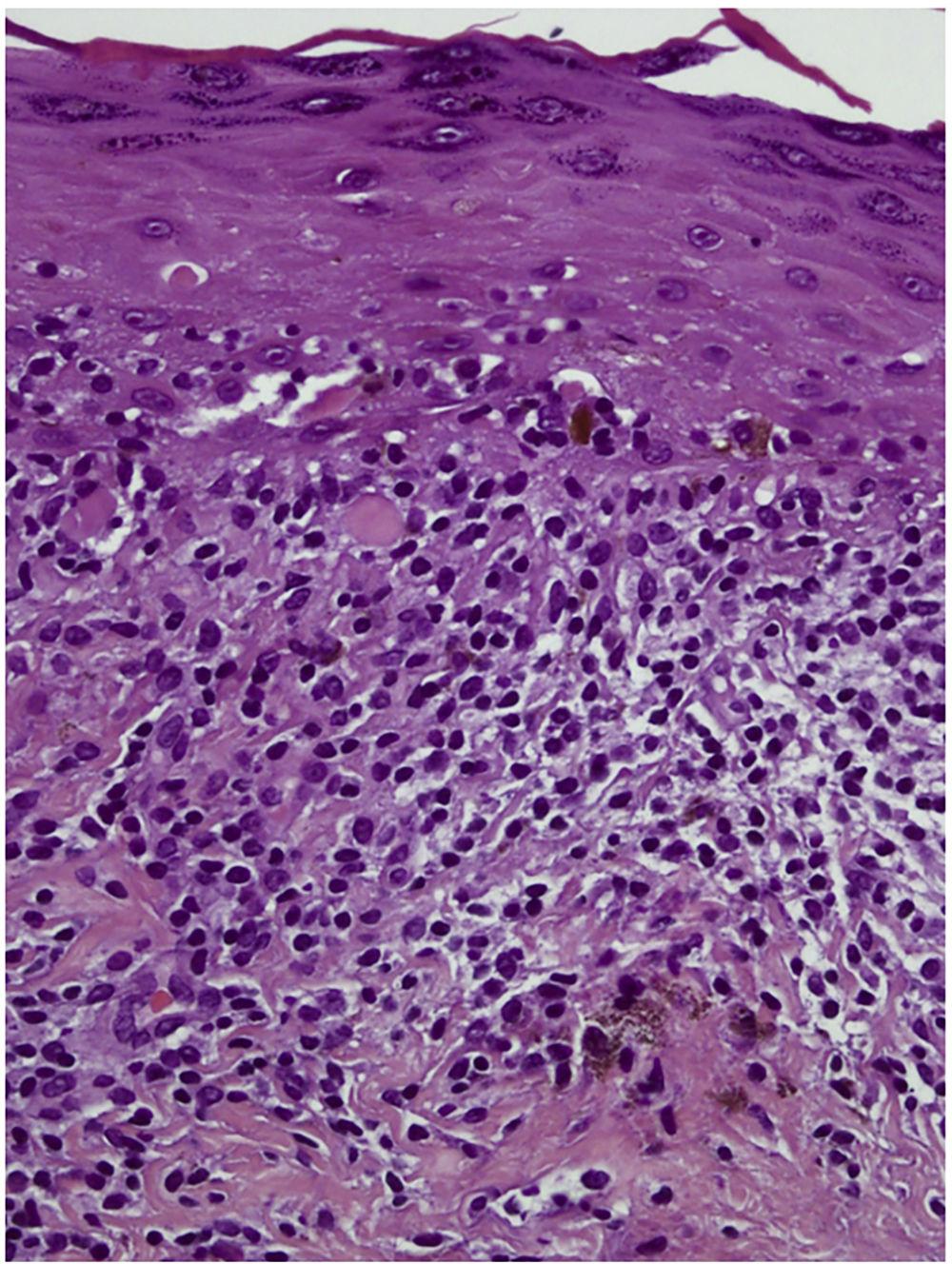 Placa anular pigmentada submentoniana | Actas Dermo-Sifiliográficas