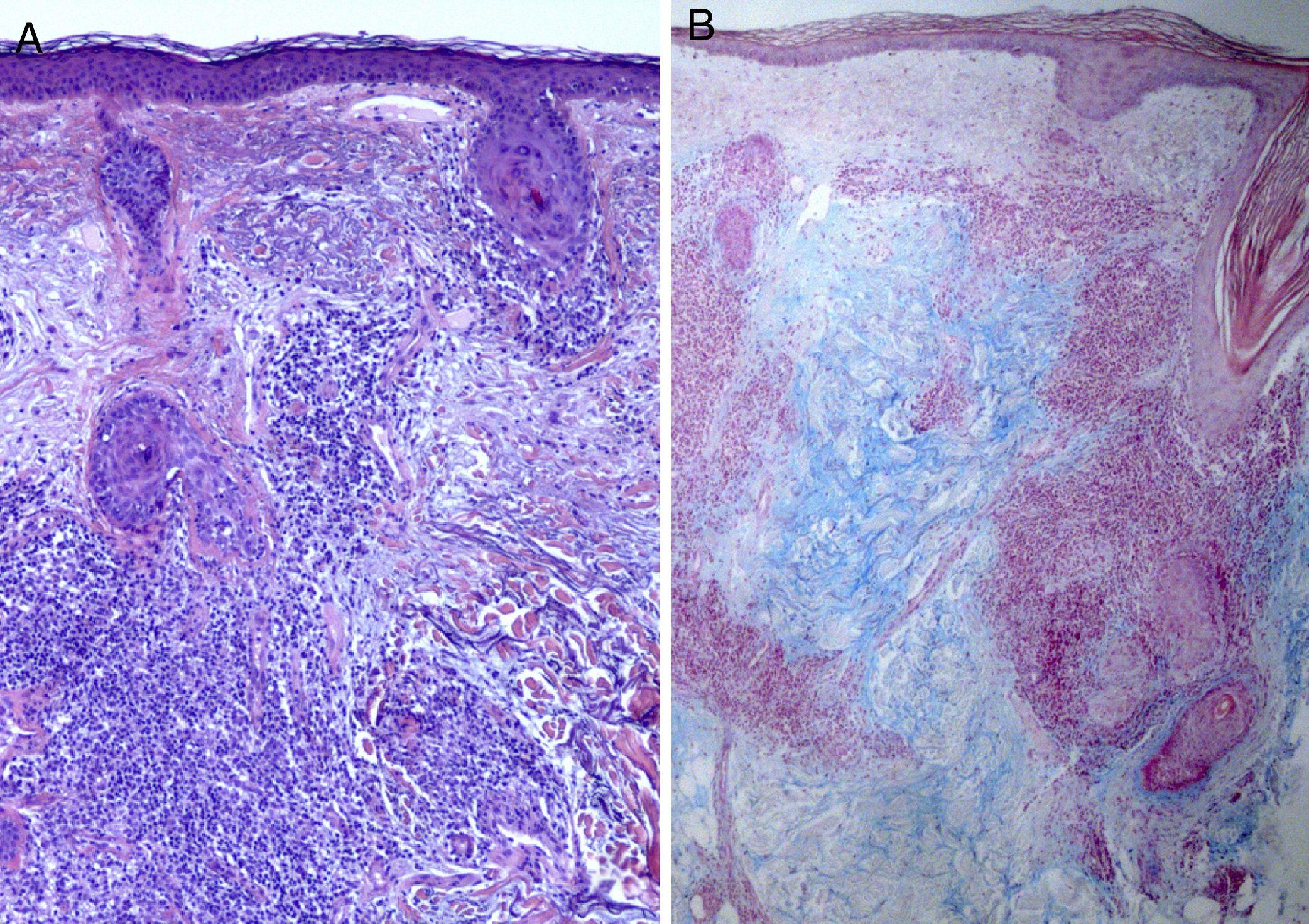 Coexistencia de lupus eritematoso túmido y lupus eritematoso discoide ...