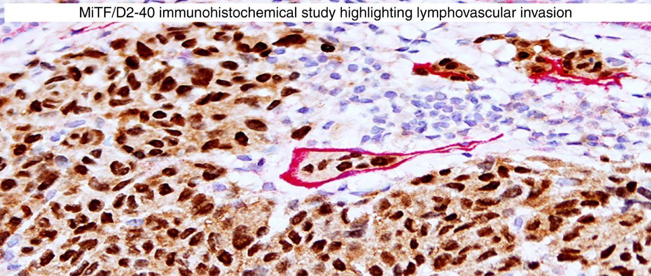Presentación atípica de infección por virus de herpes simple tipo ii ...