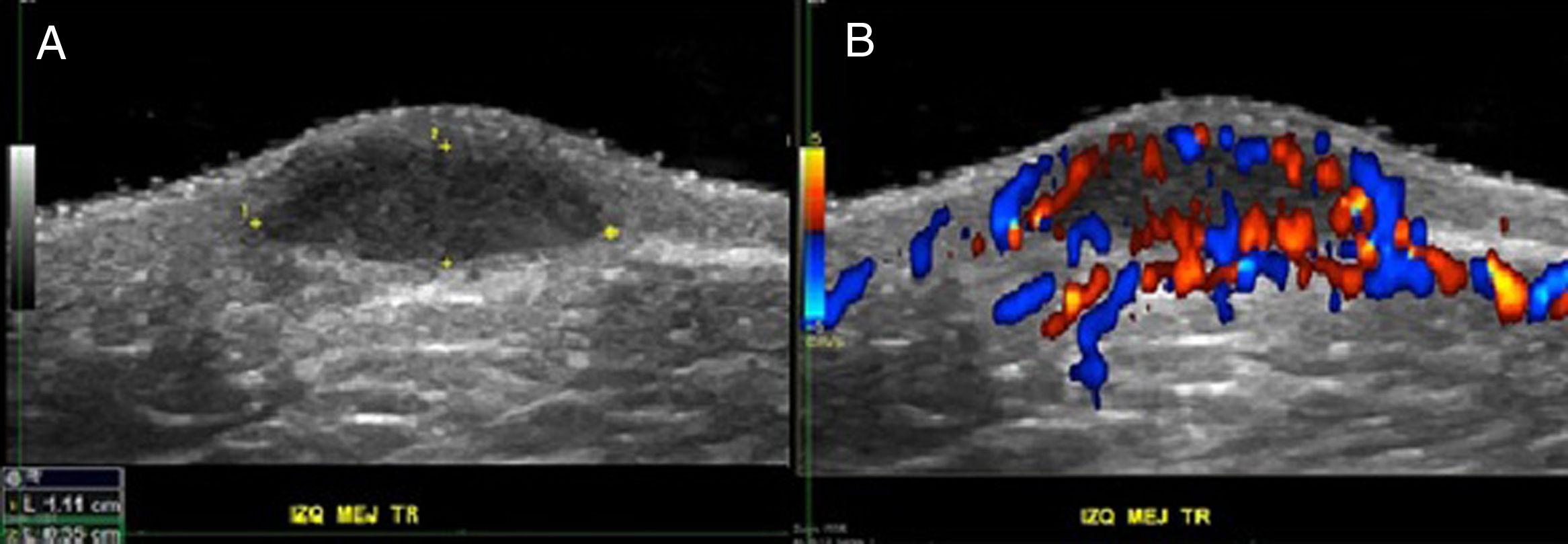 Granuloma aséptico facial idiopático: revisión actualizada de las ...