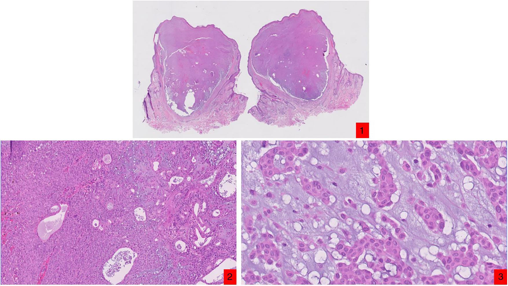 Siringoma condroide simulando un carcinoma basocelular | Actas Dermo ...