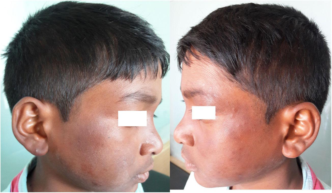 Lepra tuberculoide borderline en paciente con reacción lepromatosa tipo ...