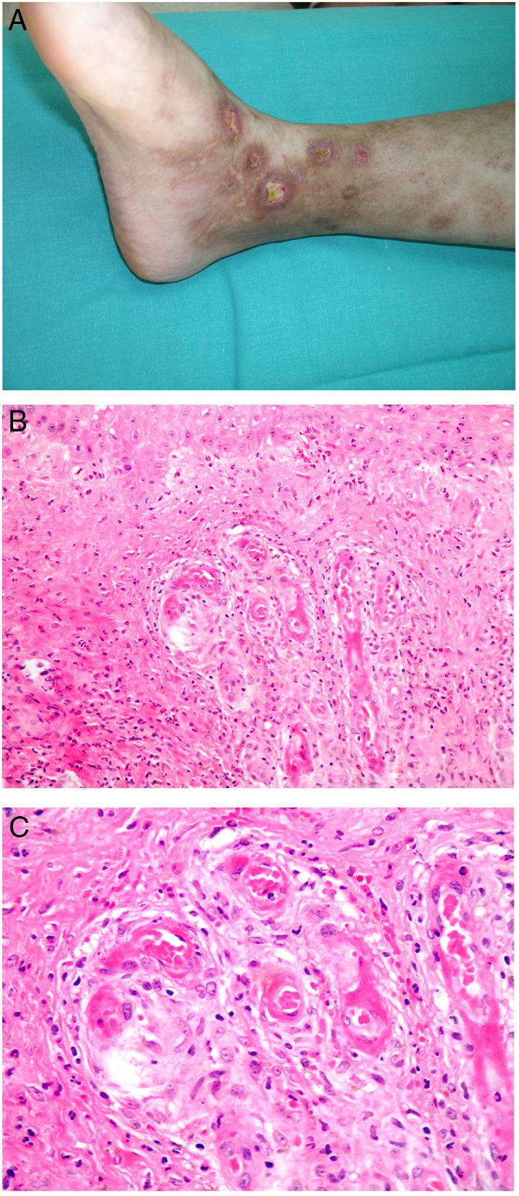 Dermatopatología de la oclusión intraluminal vascular: parteII ...