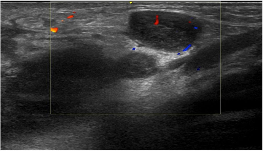 Groin Lymph Nodes Ultrasound