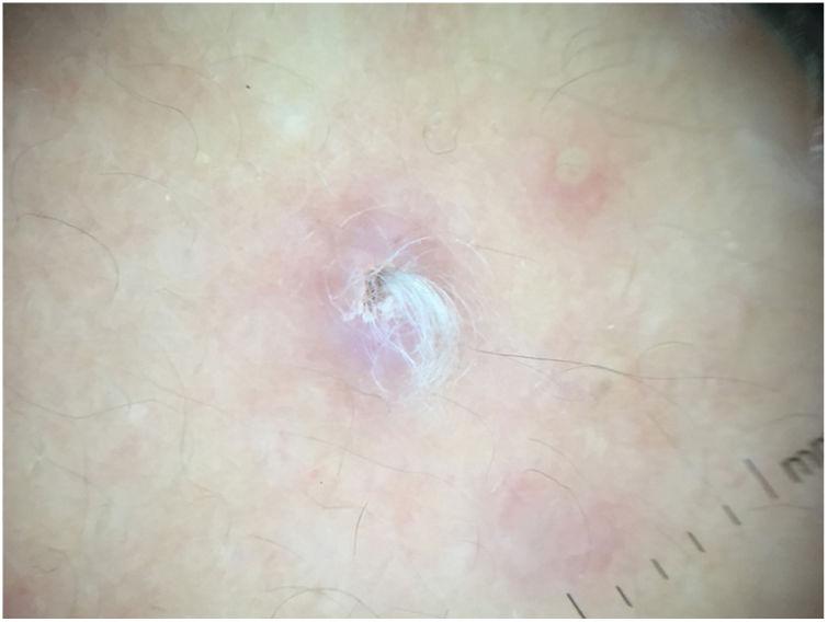 [Translated article] Vellus Hair Cyst of Several Months’ Duration on ...