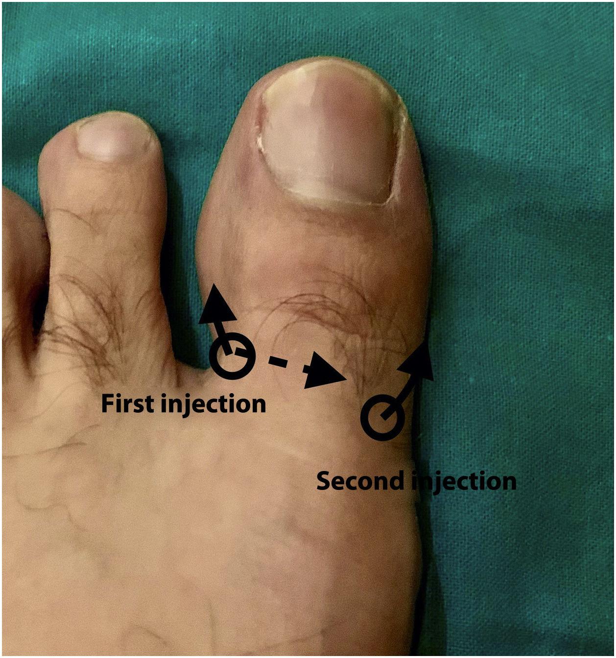[Translated article] Comparison of 2 Anesthetic Techniques in ...