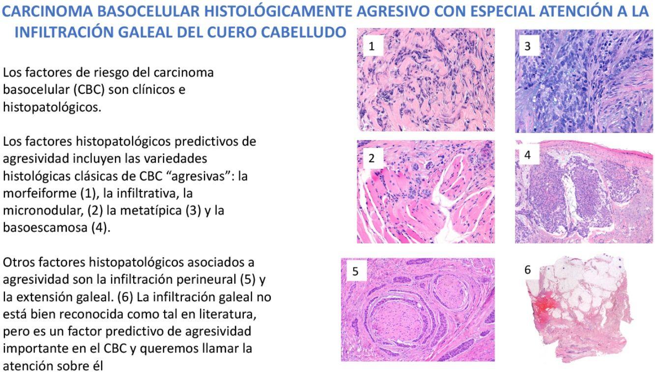Carcinoma basocelular histológicamente agresivo con especial atención a ...