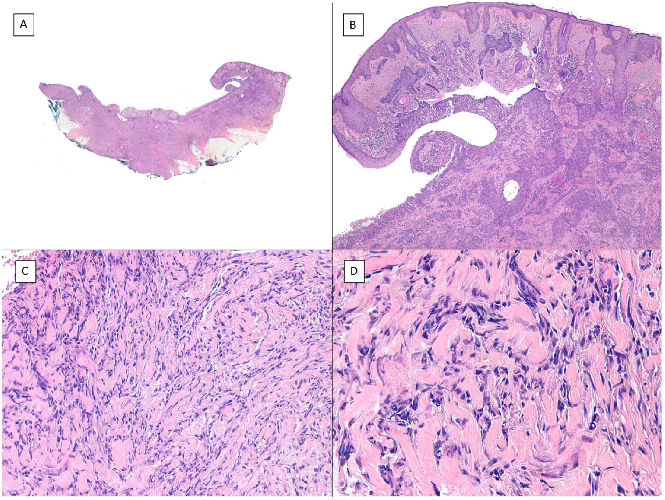 Morpheaform Basal Cell Carcinoma Histology