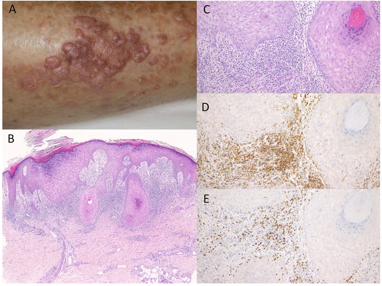 Bullous and Non-Bullous Lichen Planus During Anti PD-1 Therapy for Lung ...