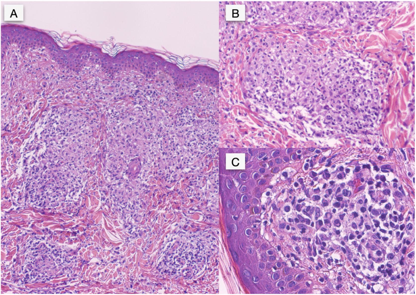 Primary Syphilis Histology