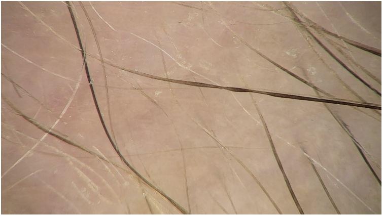 [Translated article] Trichoscopy in Alopecia Areata | Actas Dermo ...