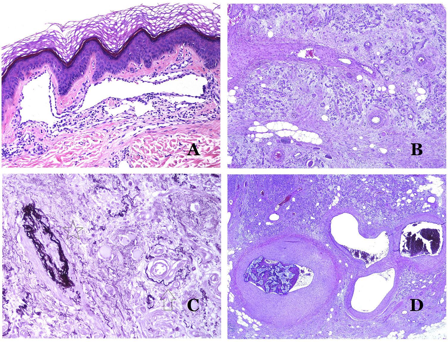 Vascular Malformations: A Histopathologic and Conceptual Appraisal ...