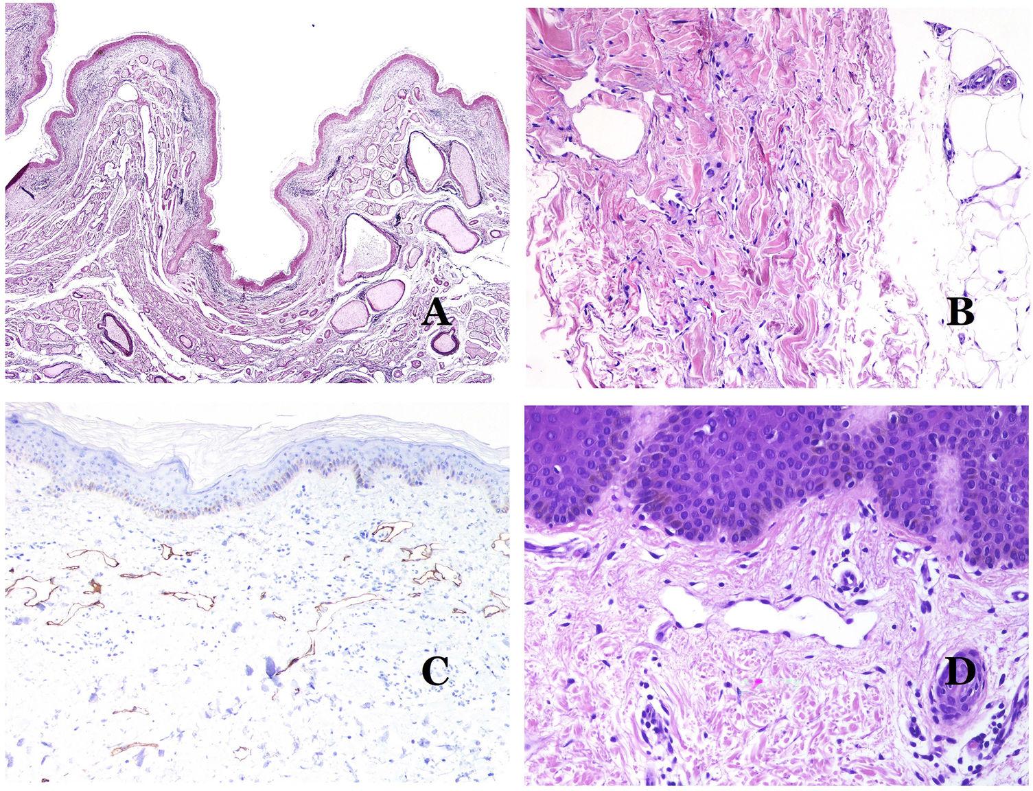 Vascular Malformations: A Histopathologic and Conceptual Appraisal ...